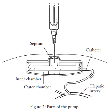 About Your Codman Implanted Liver Infusion Pump | Memorial Sloan ...