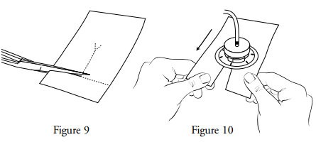 Caring for Your Nephrostomy Catheter | Memorial Sloan Kettering Cancer ...