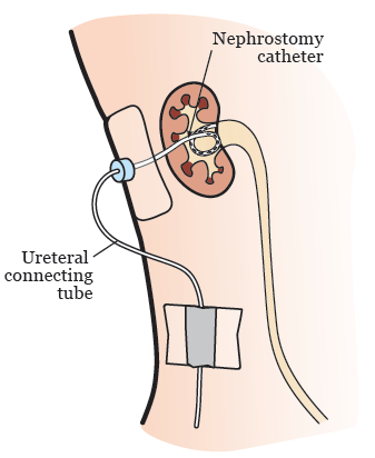 About Your Nephrostomy Catheter | Memorial Sloan Kettering Cancer Center