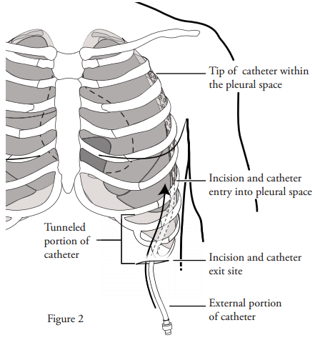 Caring for Your Pleurx Drainage Catheter - Interventional Pulmonology ...