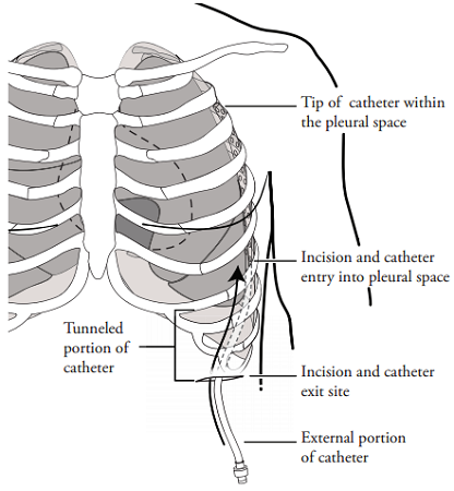 About Your PleurX Drainage Catheter - Interventional Pulmonology ...