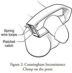 How to Use Your Cunningham Incontinence Clamp | Memorial Sloan ...