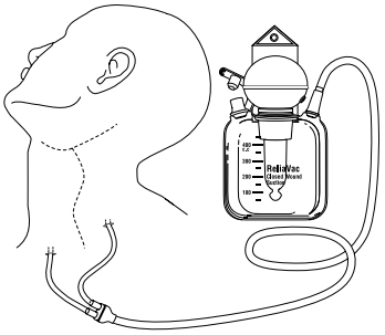 About Your Neck Dissection Surgery | Memorial Sloan Kettering Cancer Center