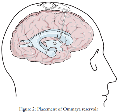 About Your Ommaya Reservoir Placement Surgery | Memorial Sloan ...