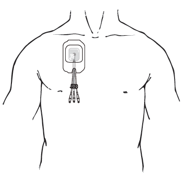 Caring for Your Central Venous Catheter (CVC) | Memorial Sloan ...