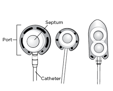 Your Implanted Port for Pediatric Patients | Memorial Sloan Kettering ...