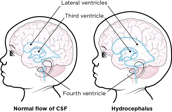 About Hydrocephalus for Pediatric Patients | Memorial Sloan Kettering ...