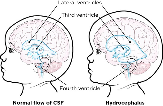 About Hydrocephalus for Pediatric Patients | Memorial Sloan Kettering ...