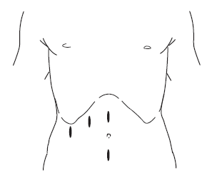 About Your Gallbladder Removal Surgery | Memorial Sloan Kettering ...