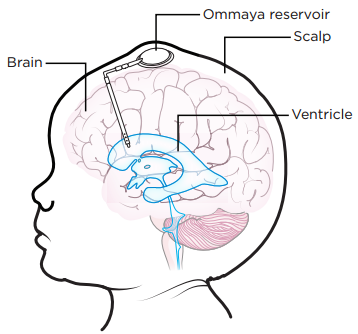 About Your Ommaya Reservoir Placement Surgery for Pediatric Patients ...