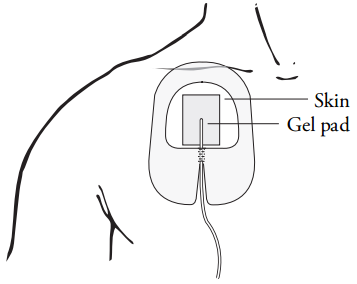 Central venkateter (CVC) information för barn | FyzGY