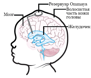 Об операции по установке резервуара Ommaya у пациентов детского ...