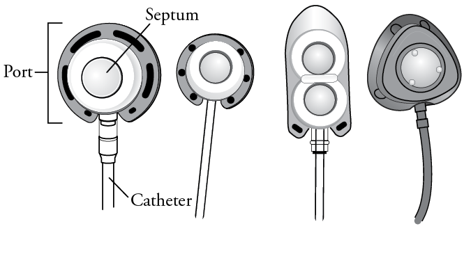 Caring for Your Implanted Port for Pediatric Patients | Memorial Sloan ...