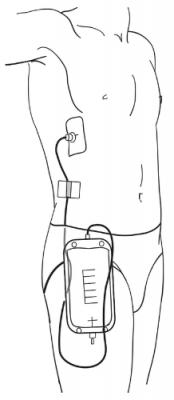 About Your Biliary Drainage Catheter | Memorial Sloan Kettering Cancer ...