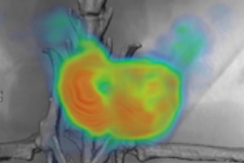 More Precise Imaging of Prostate Cancer Could Give Insight into Drug ...