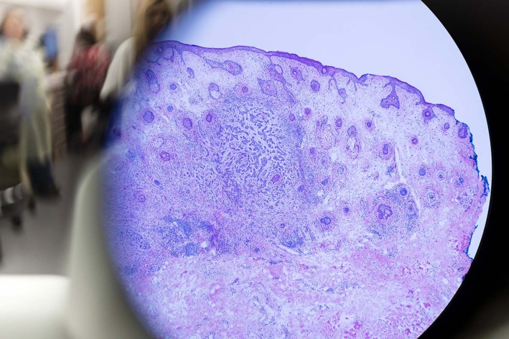 Basal Cell Carcinoma Diagnosis | Memorial Sloan Kettering Cancer Center