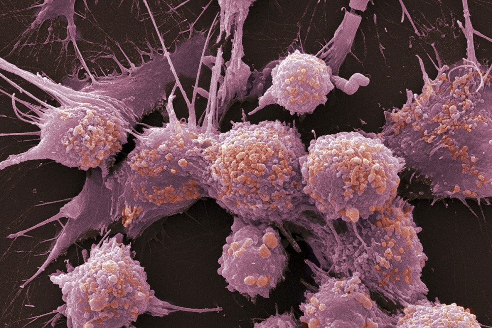 PSMA: A New Target for Prostate Cancer Treatment | Memorial Sloan ...