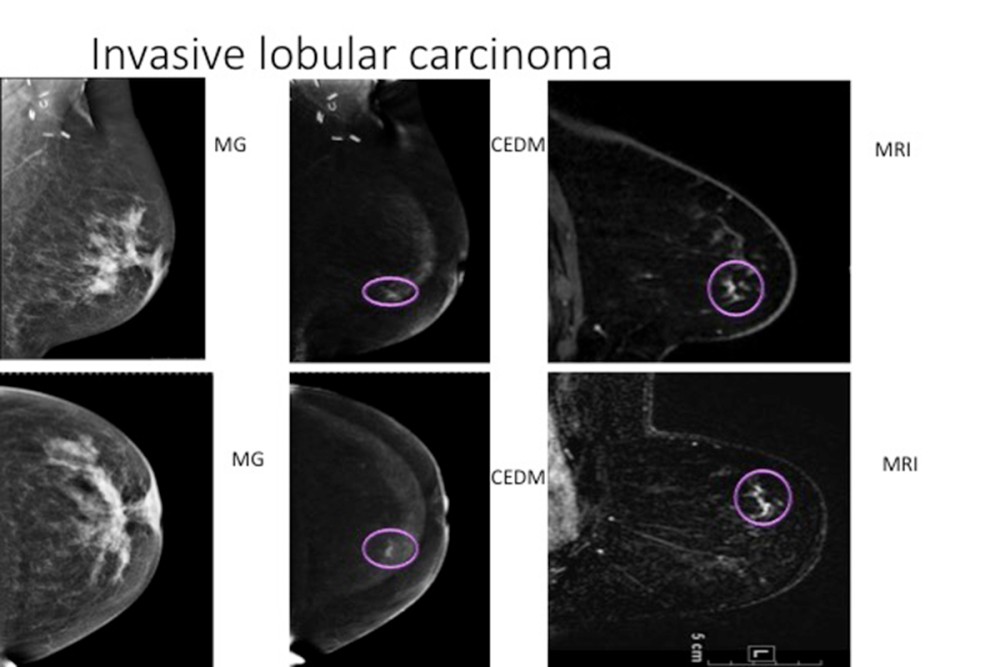Contrast-Enhanced Digital Mammograms: An Effective Alternative to MRI | Memorial Sloan Kettering ...
