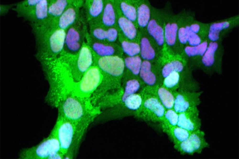 Scientists Identify How Gene Mutation Drives a Deadly Childhood Cancer ...