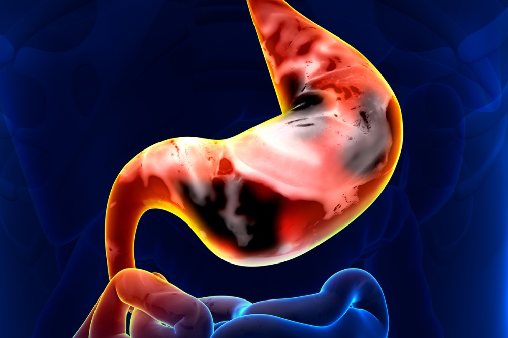 The “Pocket-Creation Method” for Resecting Early-Stage Gastrointestinal ...