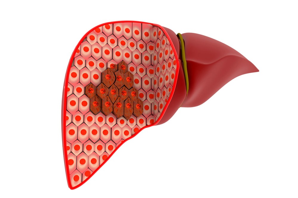 Hepatic Arterial Infusion Converts “Unresectable” Colorectal Liver Mets ...