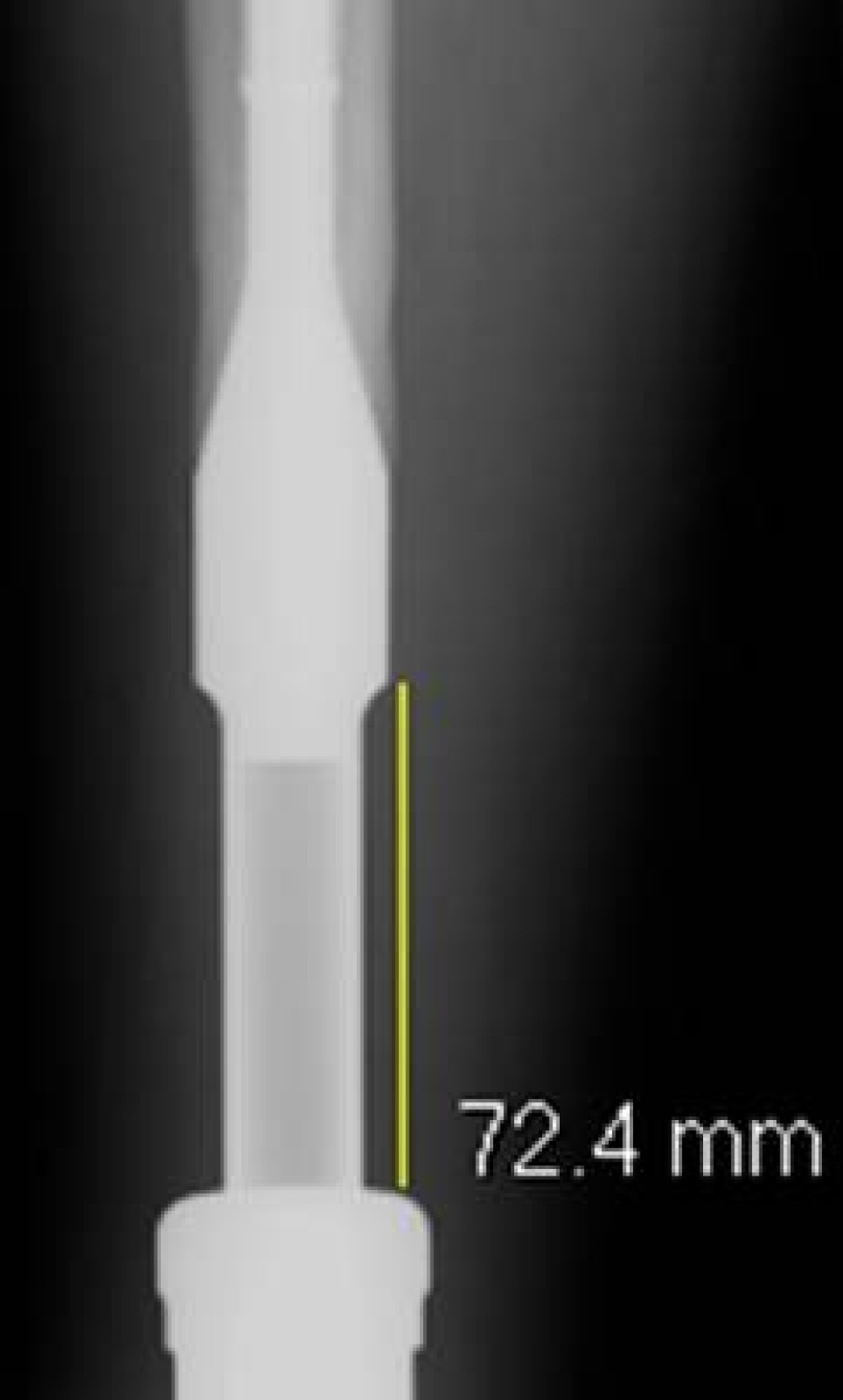 Bone Cancer: Image Bank: Expandable Prosthesis | Memorial Sloan ...
