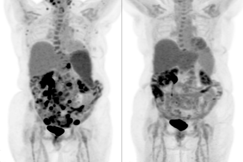 New Treatment Results for Follicular Lymphoma Clinical Trial Presented ...