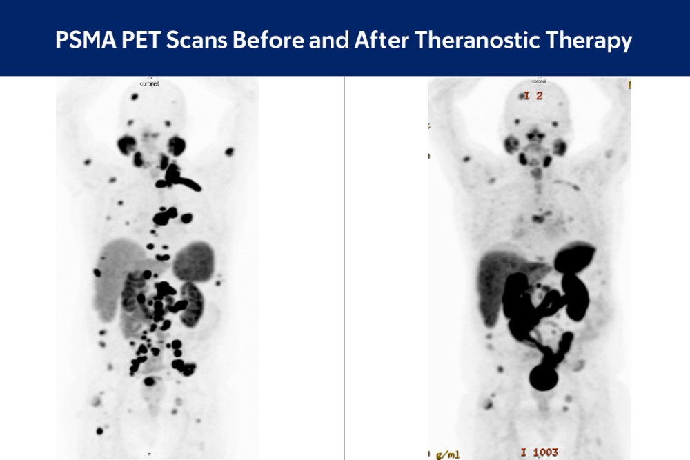 Theranostics: A Powerful Diagnostic Tool and Cancer Treatment in One ...