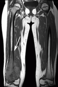 Image Bank: MRI Image of Bone | Memorial Sloan Kettering Cancer Center