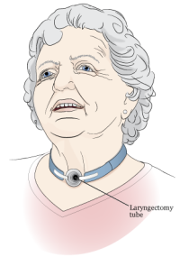 About Your Total Laryngectomy | Memorial Sloan Kettering Cancer Center