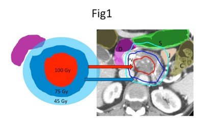 Novel Radiotherapy Technique Offers Hope for Patients with Liver and ...