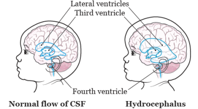 About Hydrocephalus for Pediatric Patients | Memorial Sloan Kettering ...