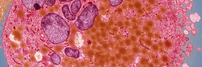 Bladder Cancer Clinical Trials and Research | Memorial Sloan Kettering ...