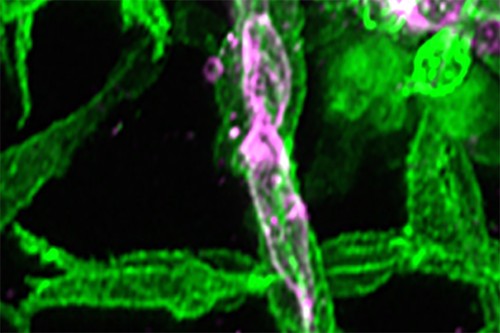 Pancreatic Cancer Spreads With Help From Schwann Cells, MSK Researchers ...