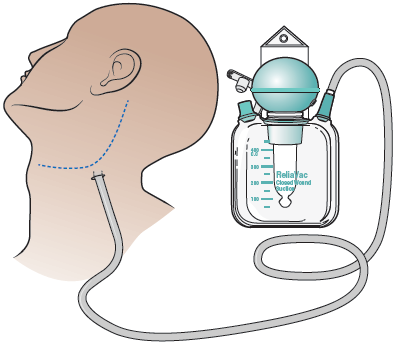 Sections from “About Your Neck Dissection Surgery” | Memorial Sloan ...