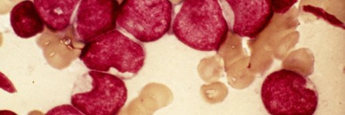 Treatment for Acute Myeloid Leukemia (AML) | Memorial Sloan Kettering ...