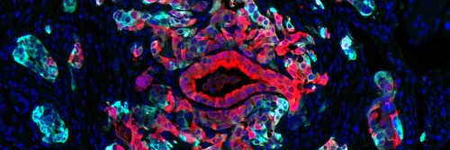 Pancreatic Cancer | Memorial Sloan Kettering Cancer Center