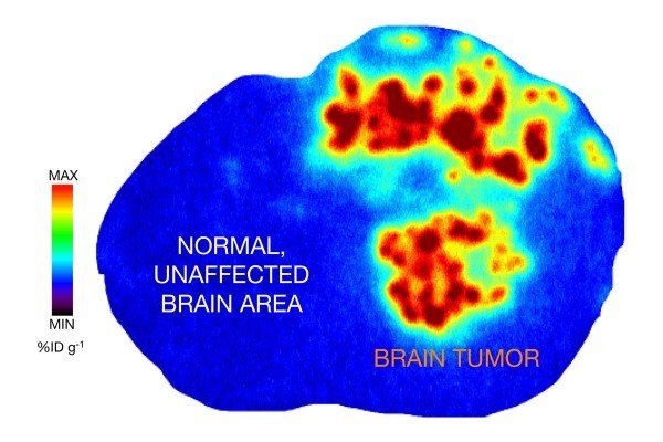 Experimental Drug Targets Misbehaving Proteins in Brain Cancer and ...