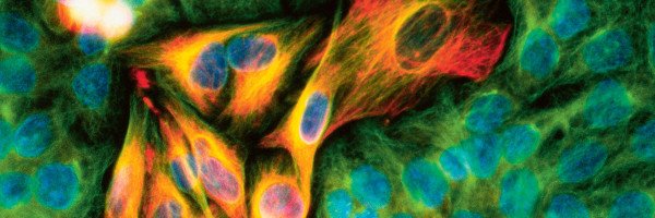 Melanoma Screening | Memorial Sloan Kettering Cancer Center