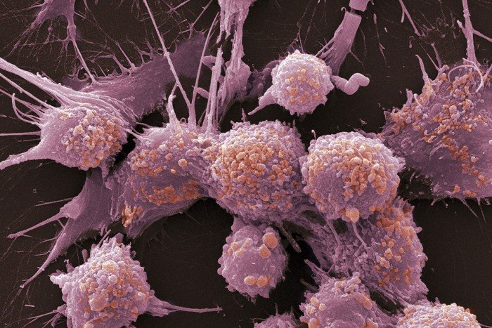 PSMA: A New Target for Prostate Cancer Treatment | Memorial Sloan ...
