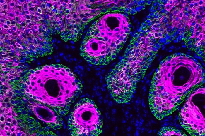 Cancer Stem Cells’ Reliance on a Key Amino Acid Could Be an Exploitable ...