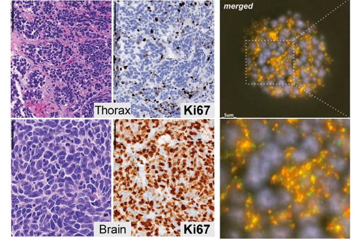 Atypical Small Cell Carcinoma, a Rare Type Lung Cancer, Identified by ...