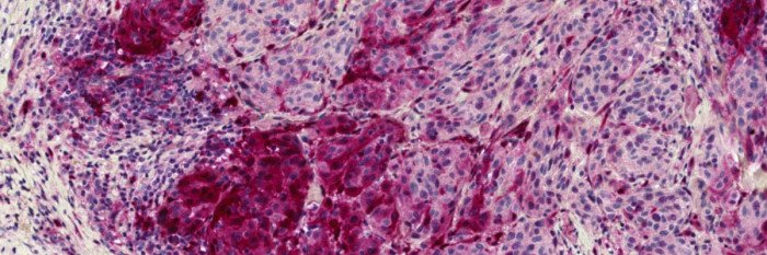 One by One: Single-Cell Analysis Helps Map the Cancer Landscape ...