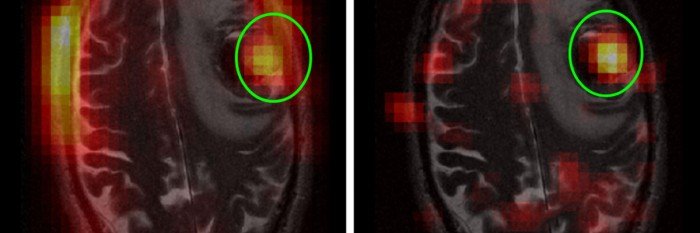 Primary Brain Tumors | Memorial Sloan Kettering Cancer Center