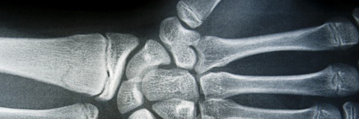 Surgery for Soft Tissue Sarcoma | Memorial Sloan Kettering Cancer Center