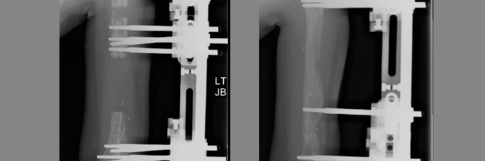 What’s New in Osteosarcoma and Other Bone Cancers | Memorial Sloan ...