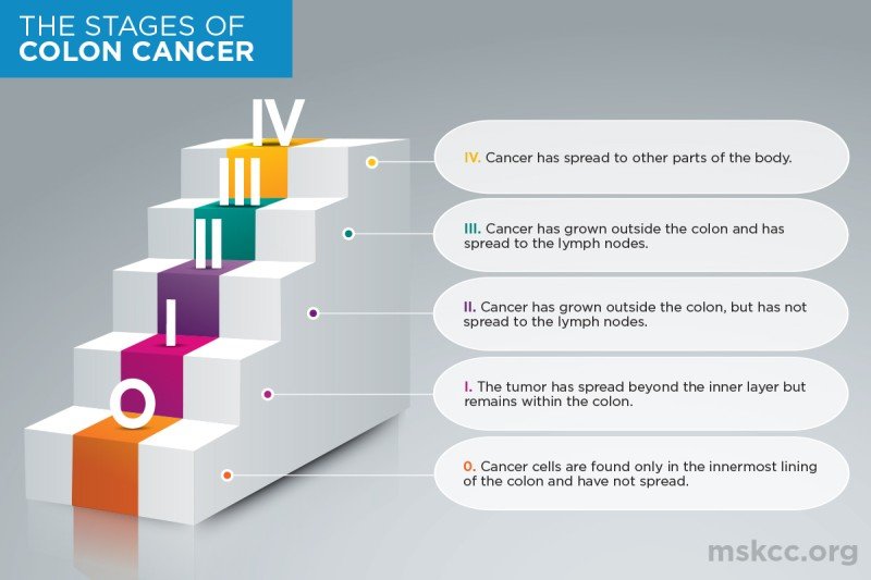 Colon Cancer Stages 0, 1, 2, 3, 4 | Memorial Sloan Kettering Cancer Center
