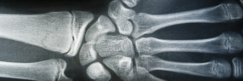 Bone Cancer | Memorial Sloan Kettering Cancer Center