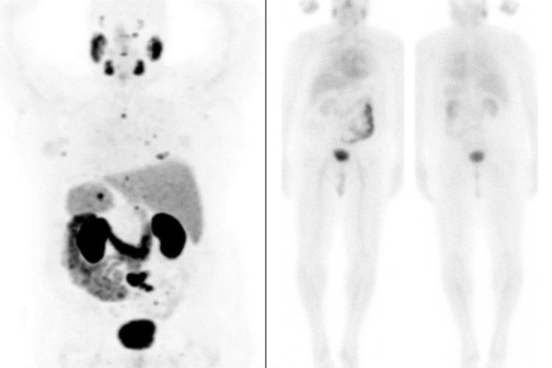FDA Expands New Treatment for Metastatic Prostate Cancer: Targets a ...