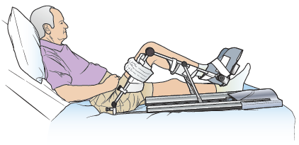 About Your Knee Replacement Surgery | Memorial Sloan Kettering Cancer ...